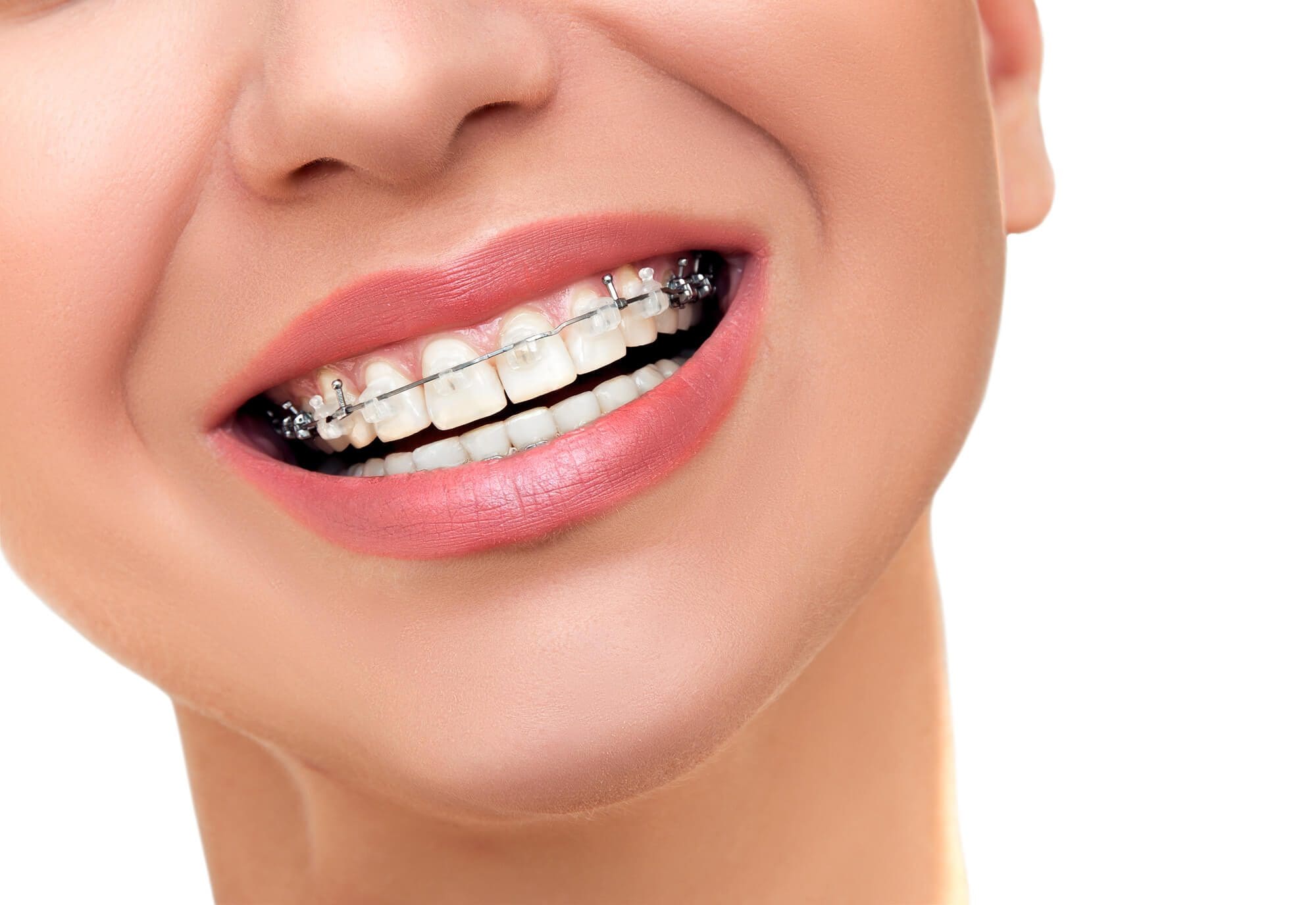 Different Phases of Braces Treatment | Smilebliss