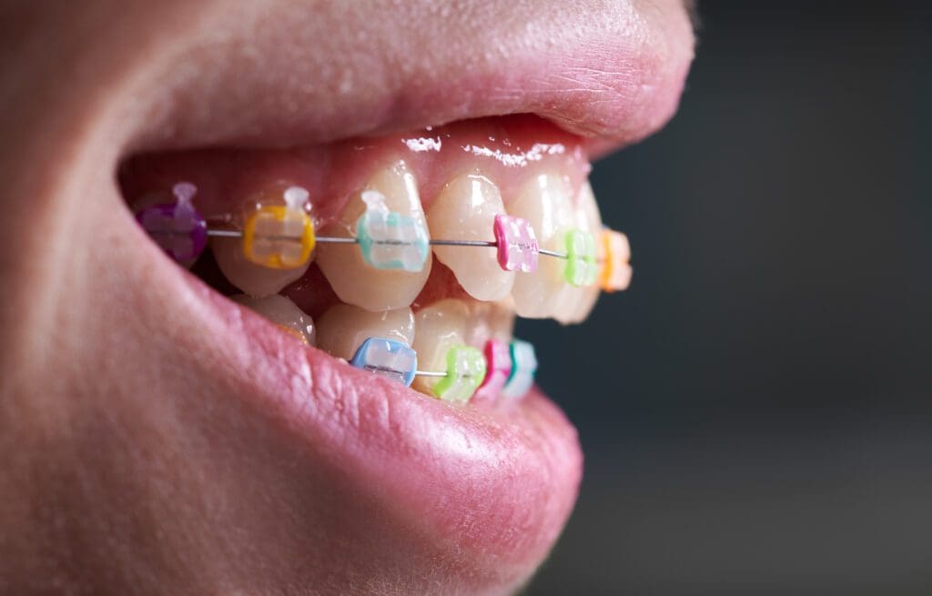 Best Braces Colors | Smilebliss