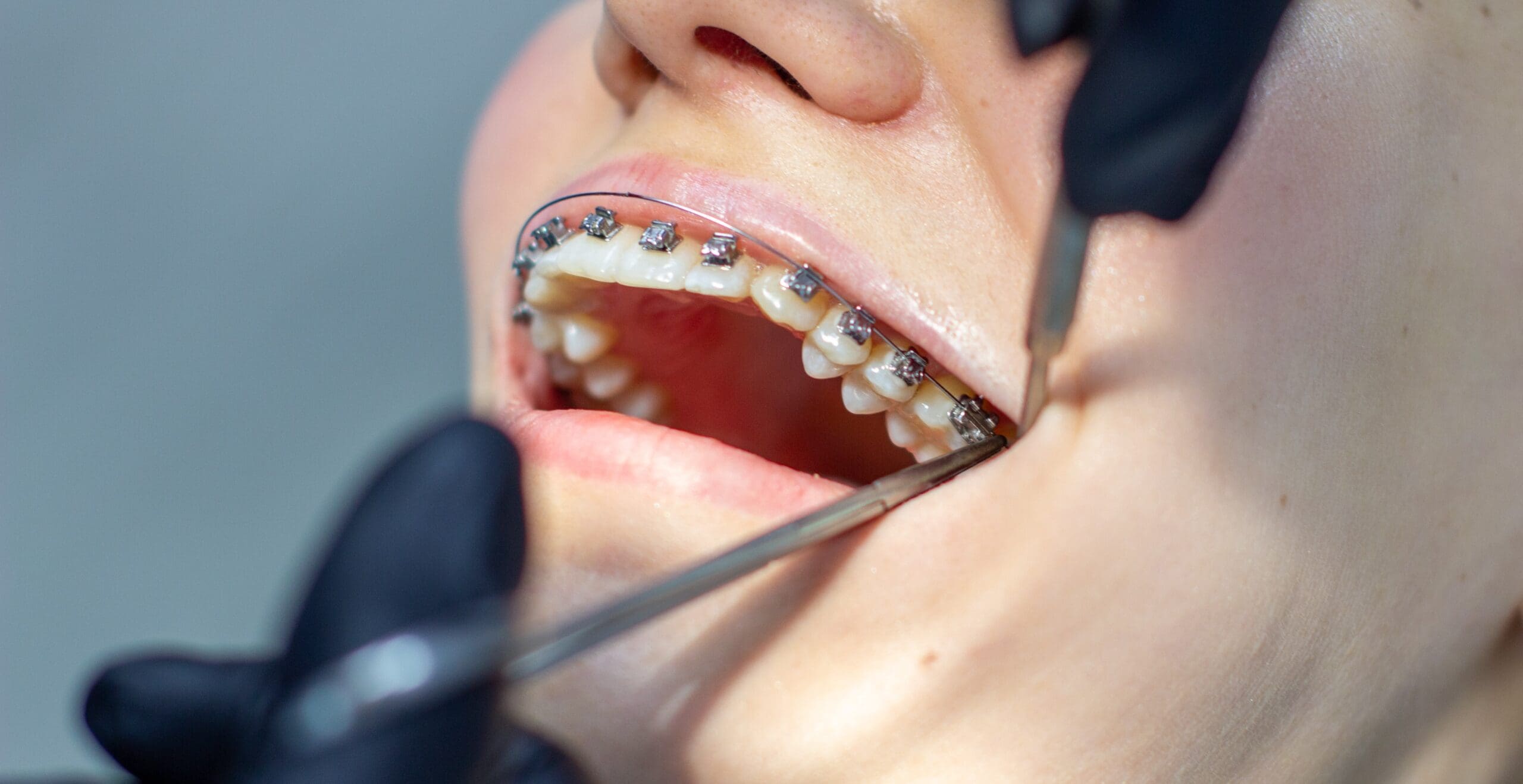 Take out braces store