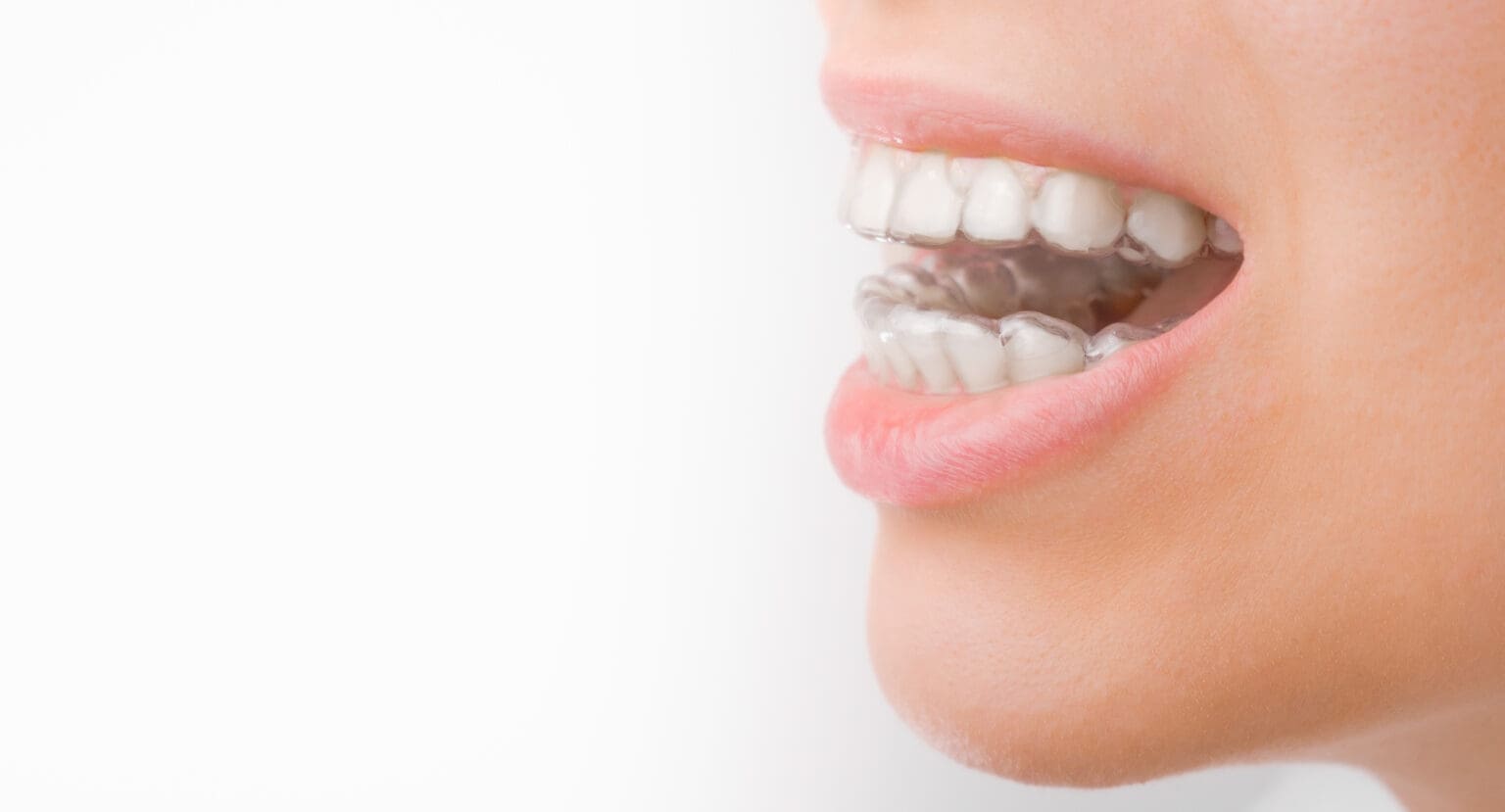 When Your Aligners Don’t Fit: Practical Solutions to Try | Smilebliss