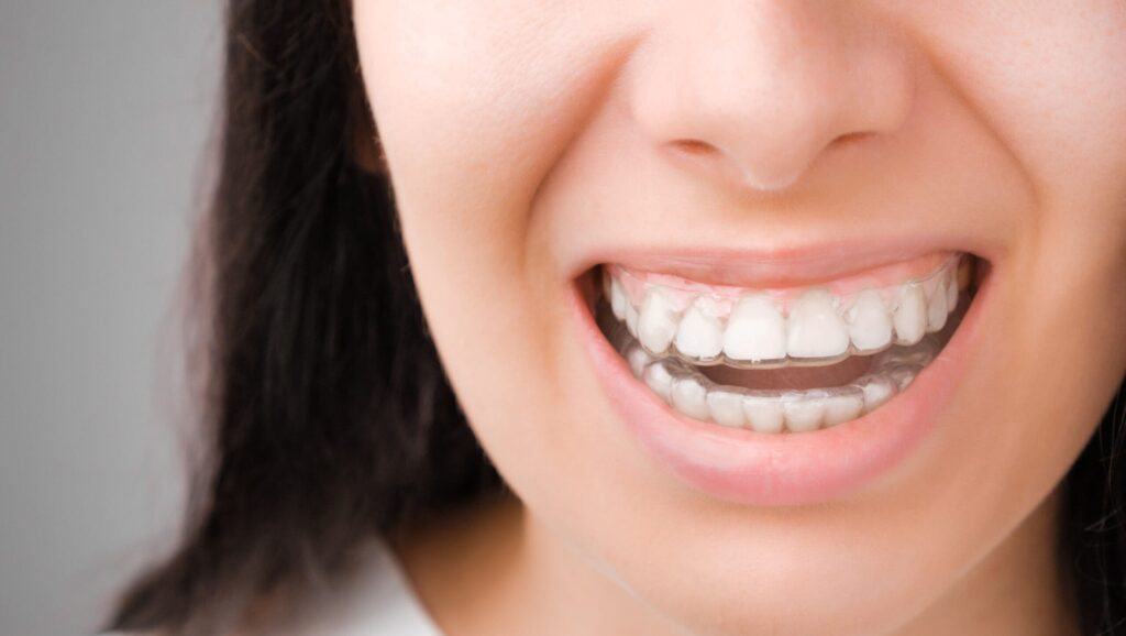 How Clear Aligners Are Changing Orthodontics | Smilebliss
